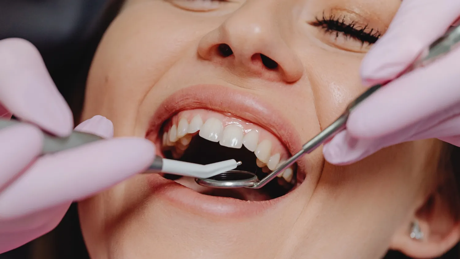 Dental Fillings: Cost, Materials, Processes, and Lifespan